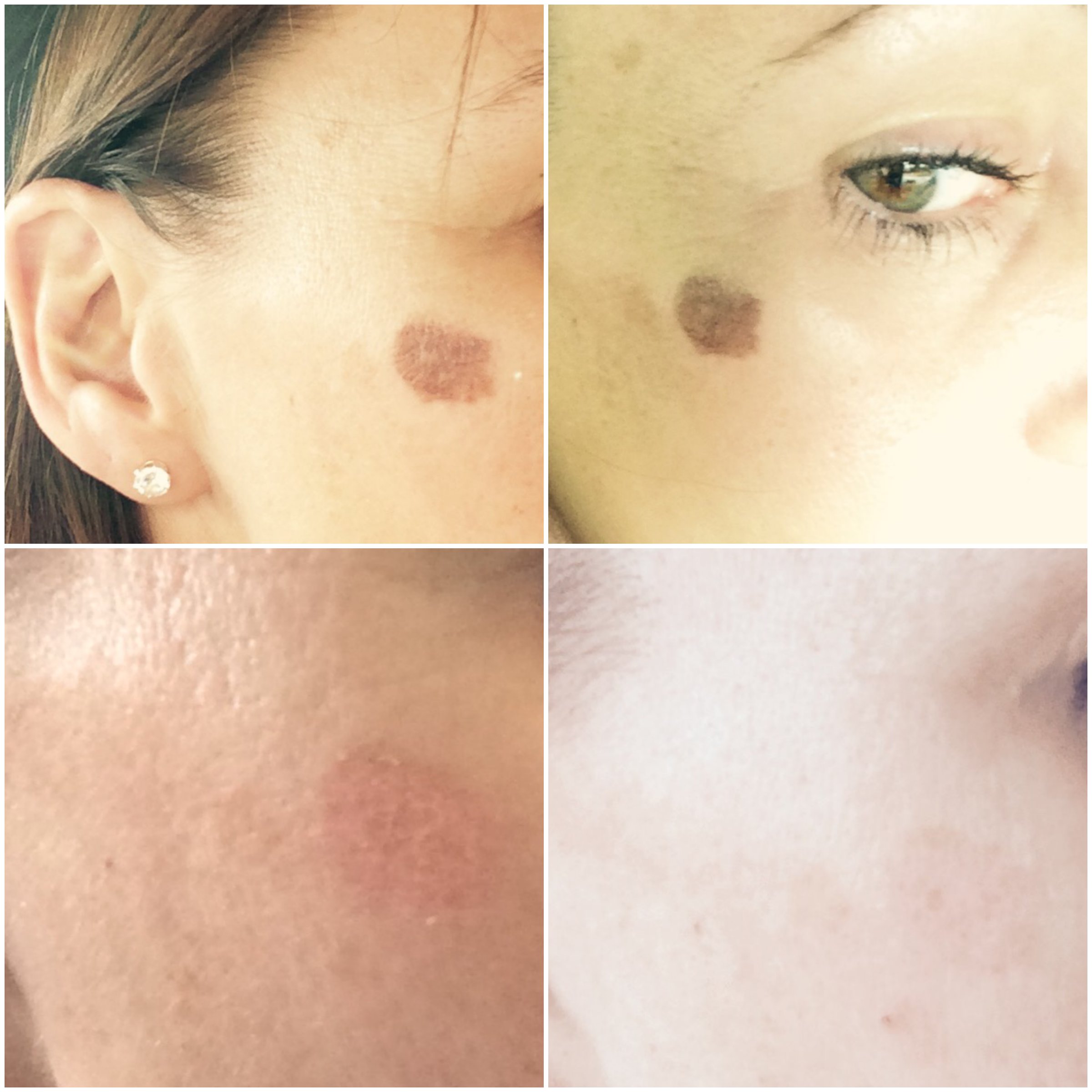 CryoPen - Ellis Taylor Beauty Studio